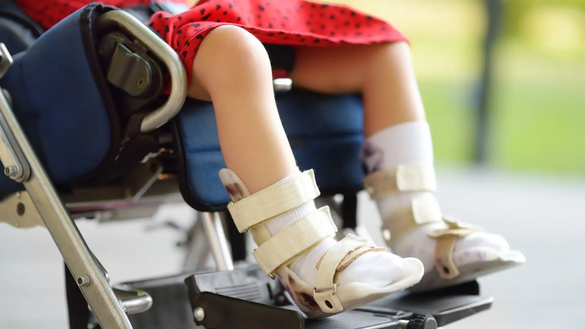 Diplegia Vs. Other Forms Of Cerebral Palsy